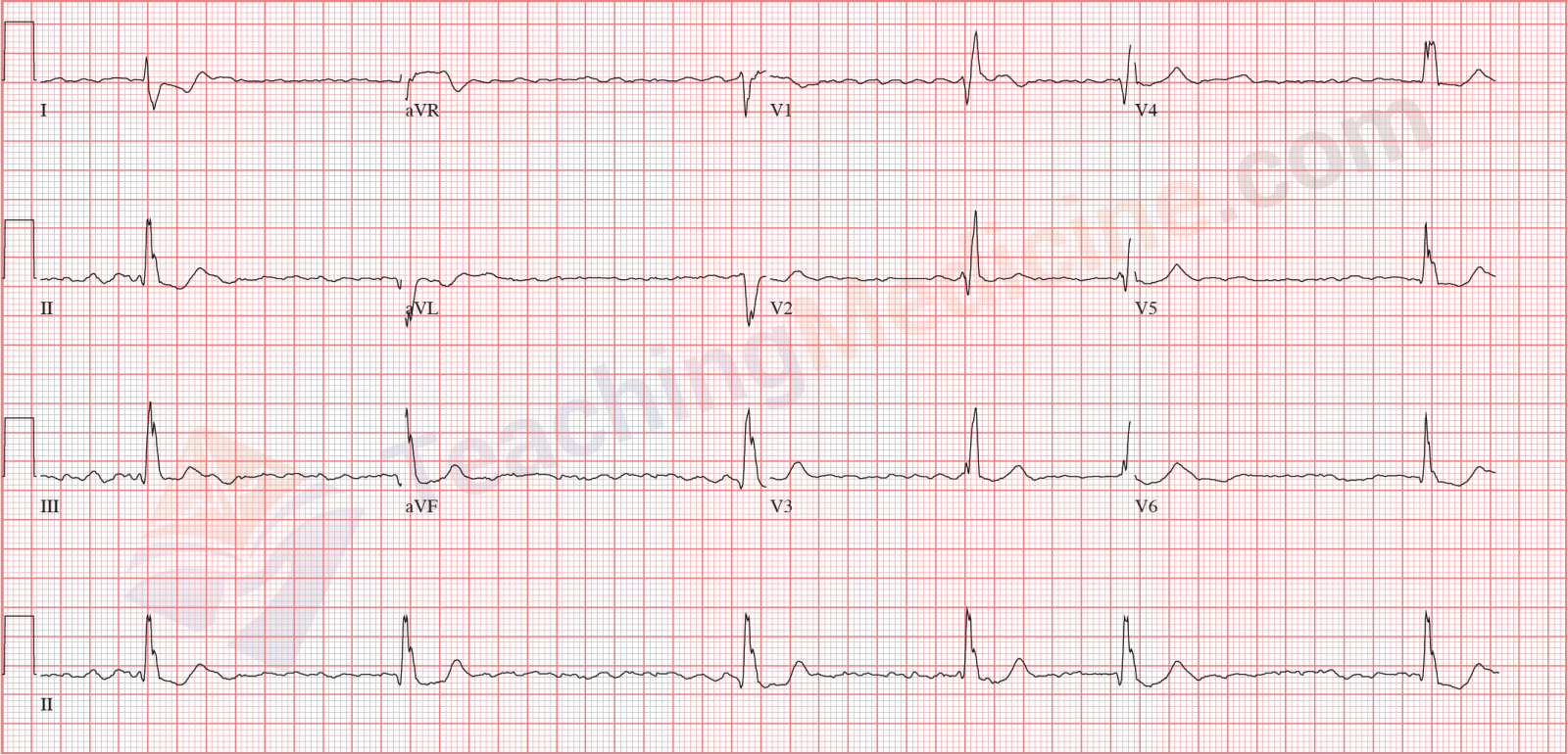 Teaching Medicine - Tutorial: Rhythm Diagnostic Criteria